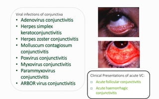 viral conjuctivitis | PPTX