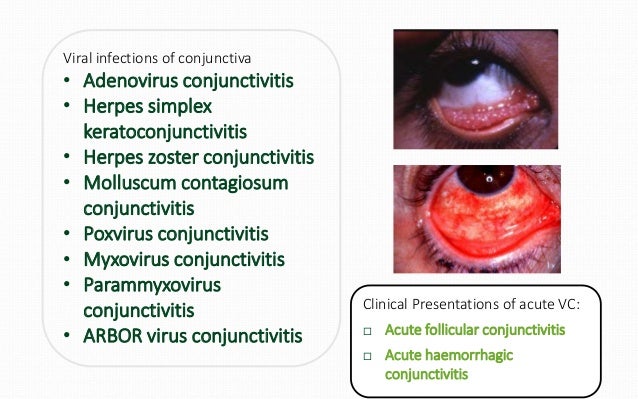 viral conjuctivitis