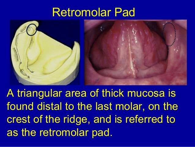 Retromolar Pad Anatomy Of The Completely Edentulous Patient (Mandible)