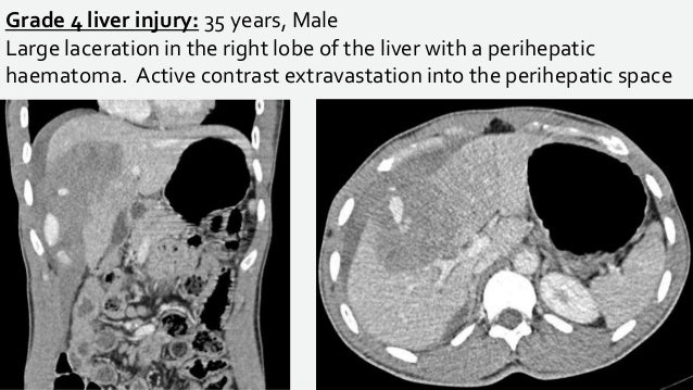 liver injury