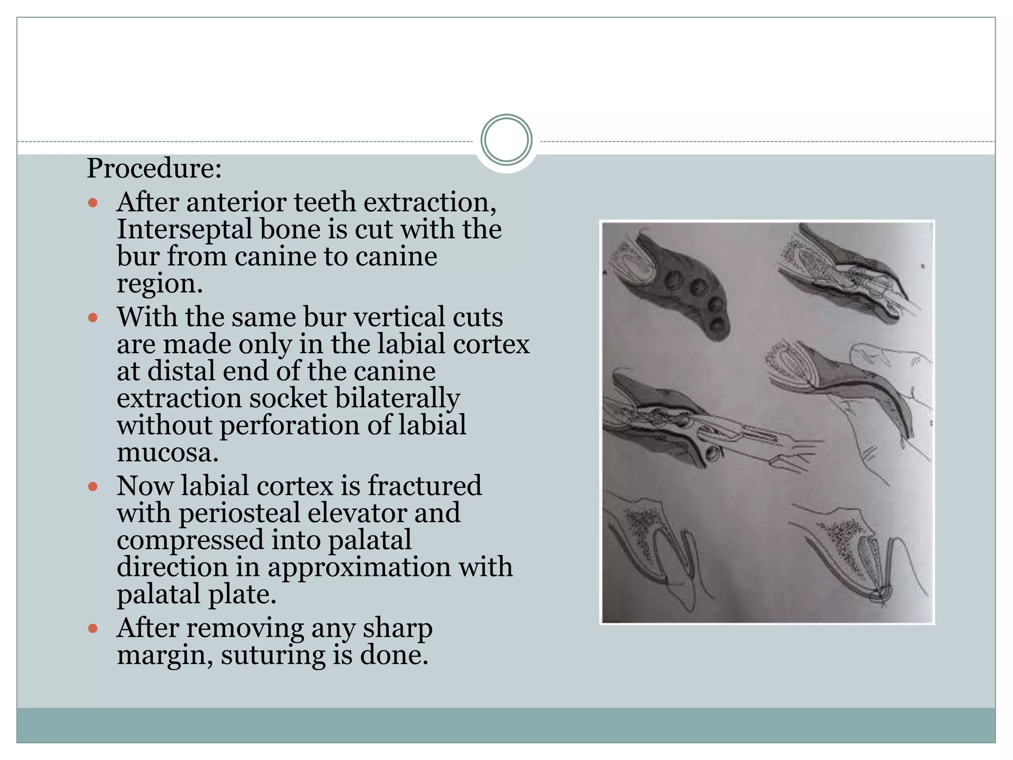 Pre Prosthetic Surgery | PPTX