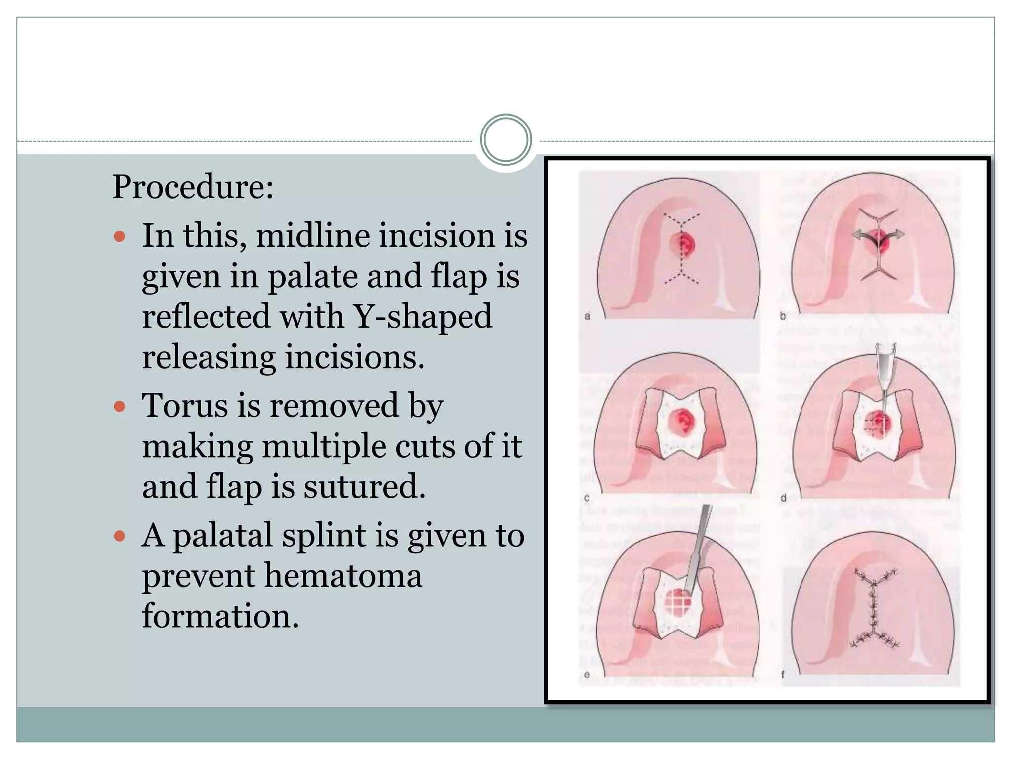 Pre Prosthetic Surgery | PPTX