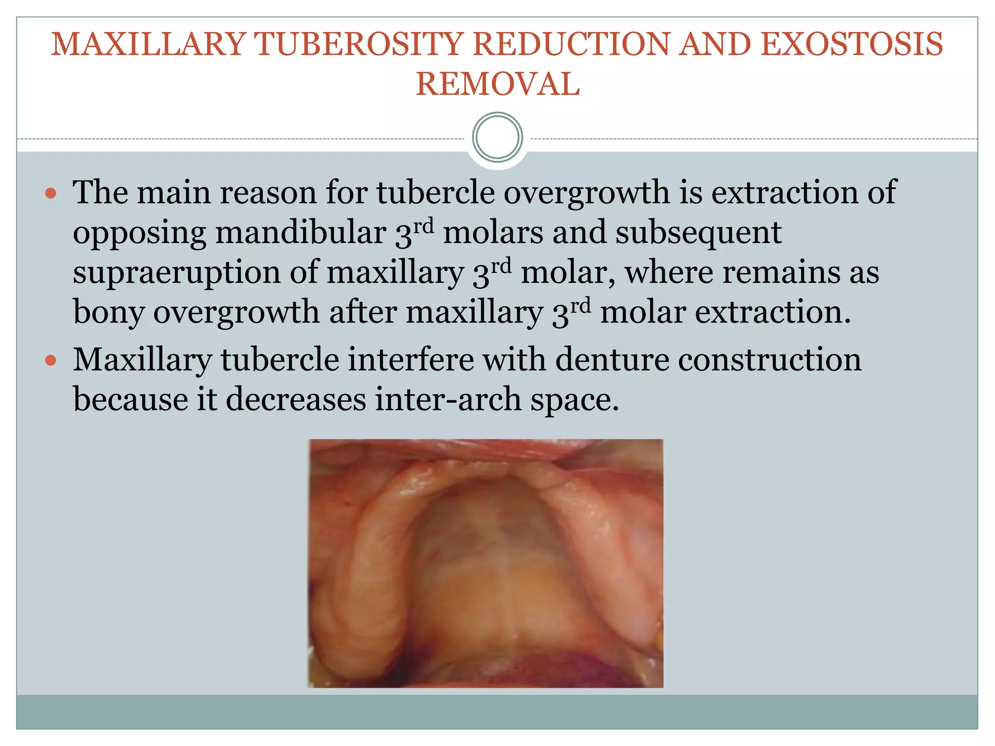 Pre Prosthetic Surgery | PPTX