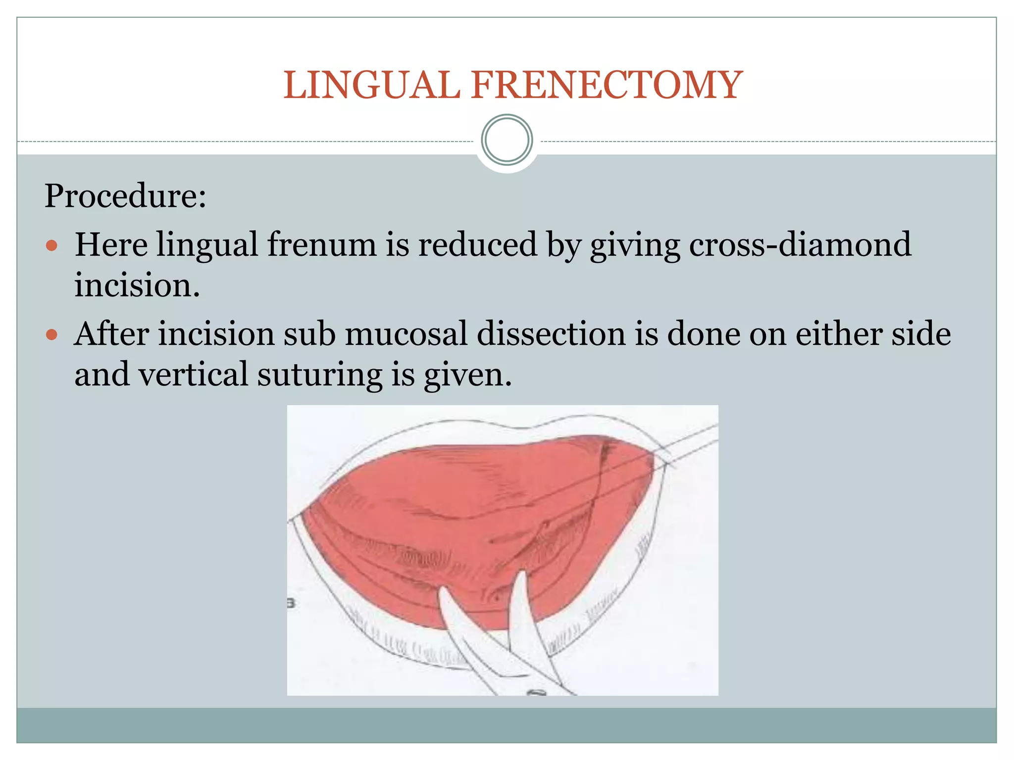 Pre Prosthetic Surgery | PPTX