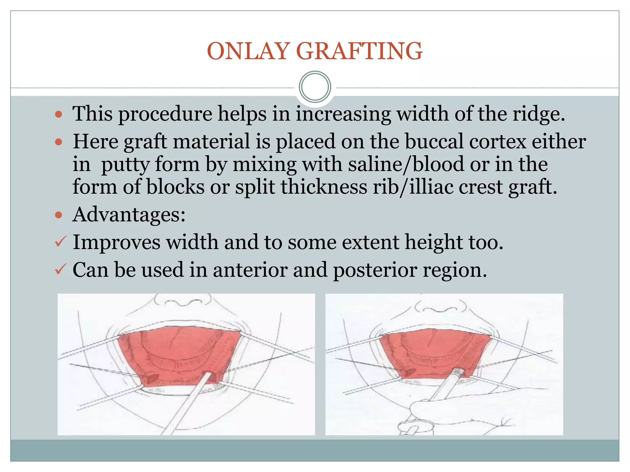 Pre Prosthetic Surgery | PPTX