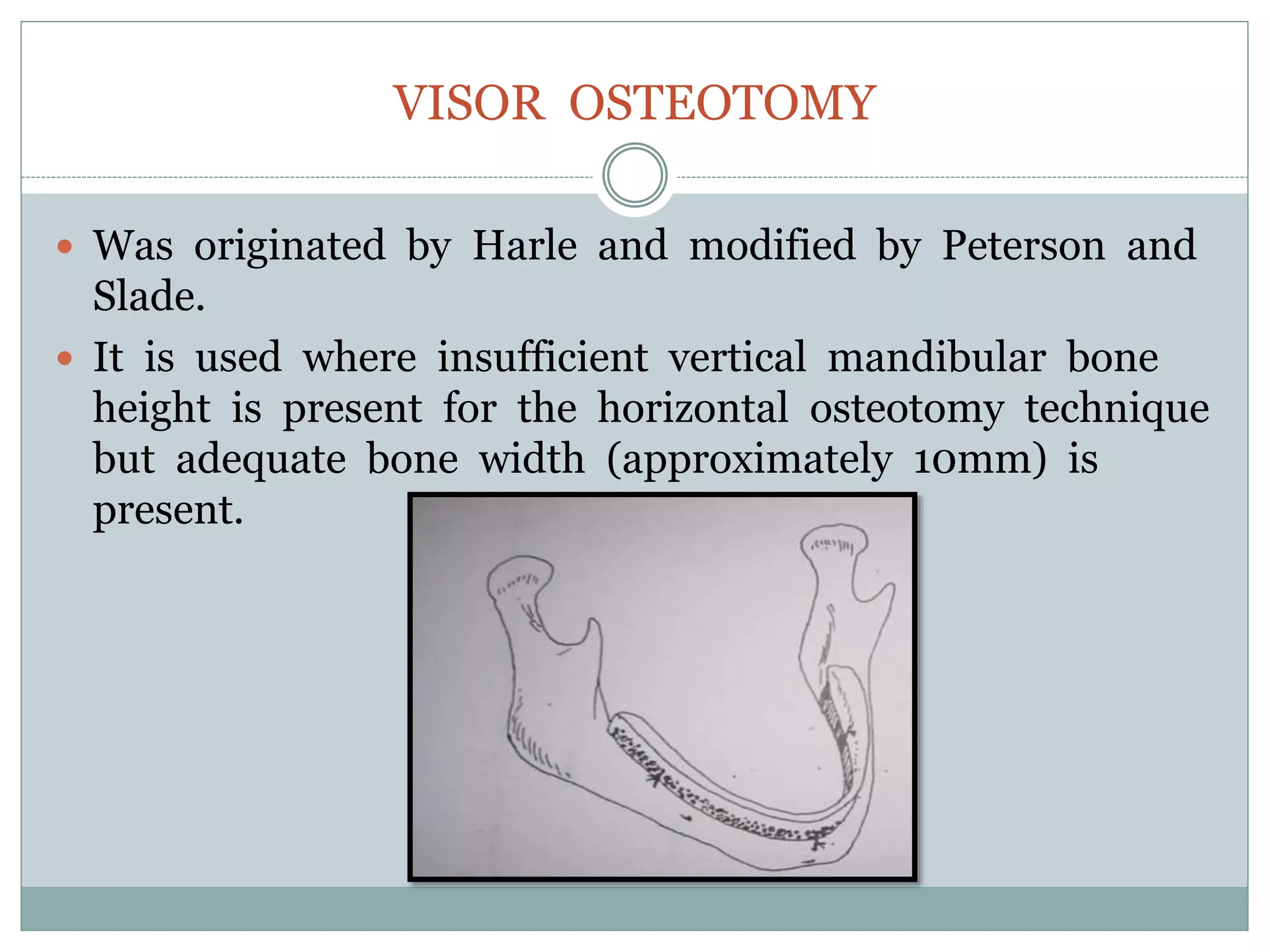 Pre Prosthetic Surgery | PPTX