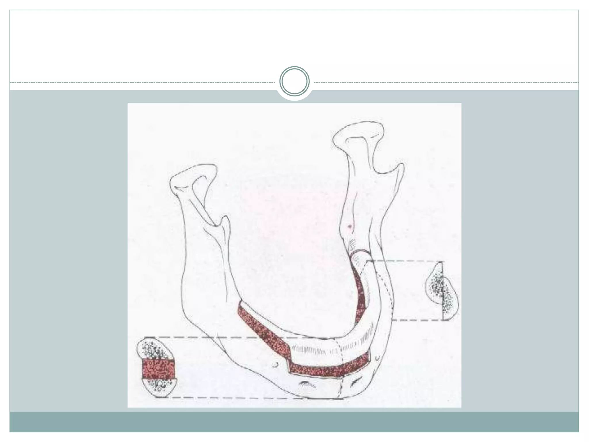 Pre Prosthetic Surgery | PPTX