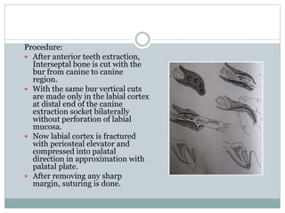 Pre Prosthetic Surgery | PPTX