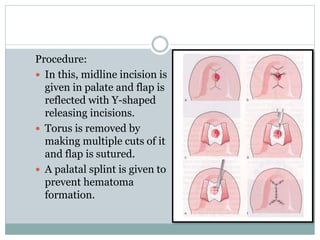 Pre Prosthetic Surgery | PPTX