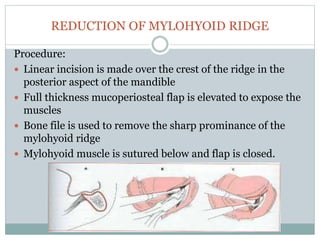Mylohyoid Ridge Reduction
