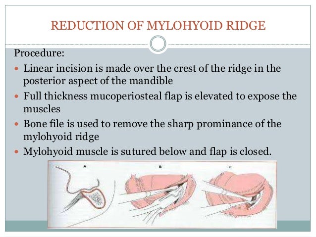 Mylohyoid Ridge