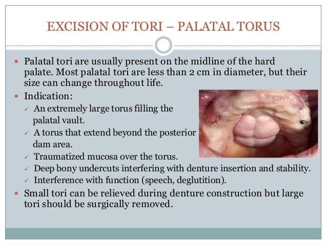Pre Prosthetic Surgery