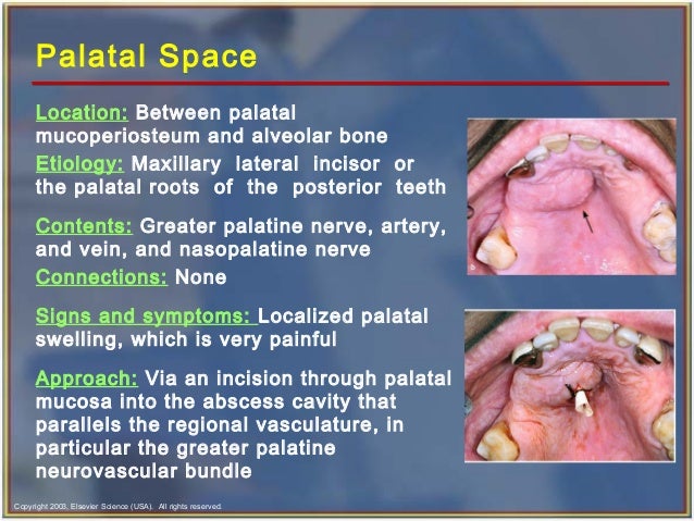 Complex odontogenic infections