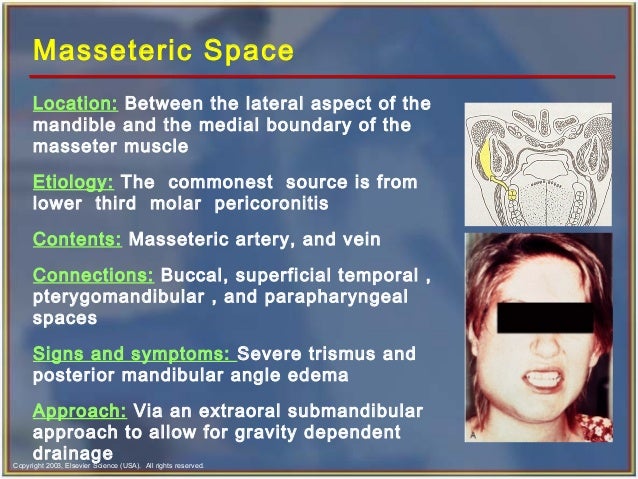 Complex odontogenic infections