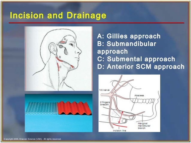 Complex odontogenic infections