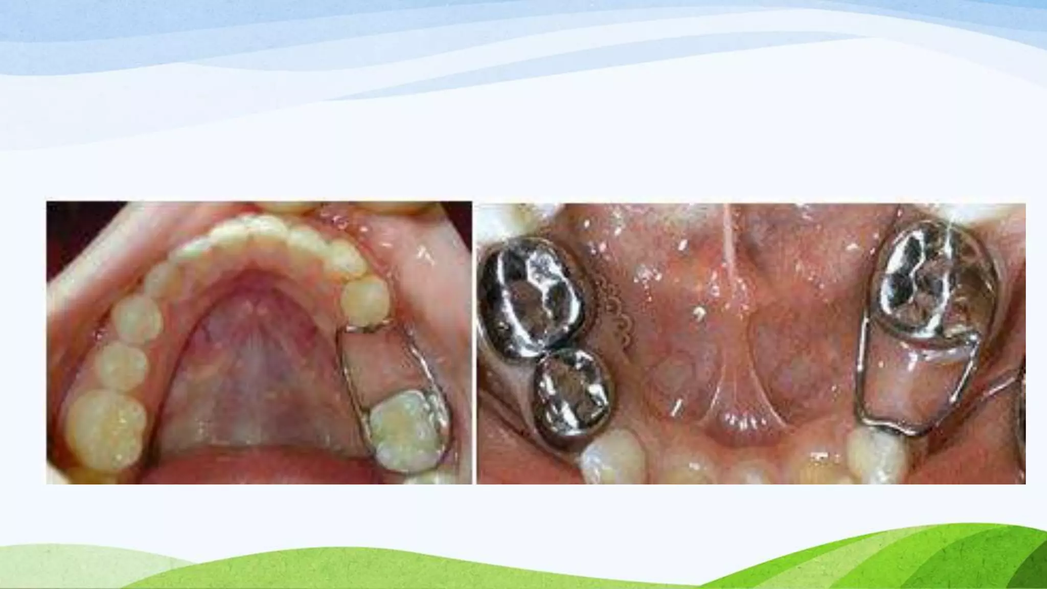 space management in Deciduous teeth | PPTX