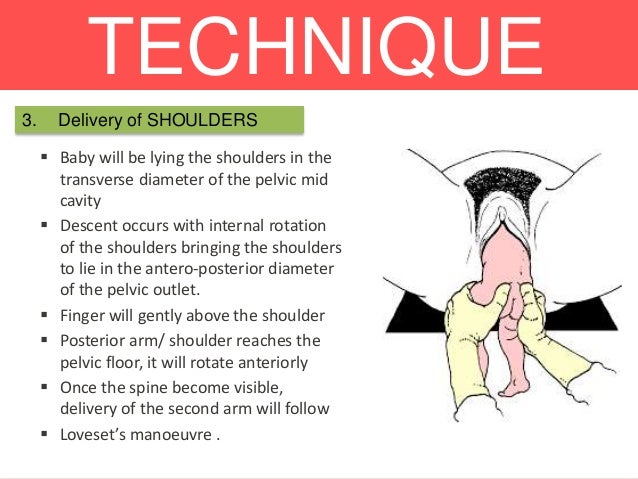 Breech presentation