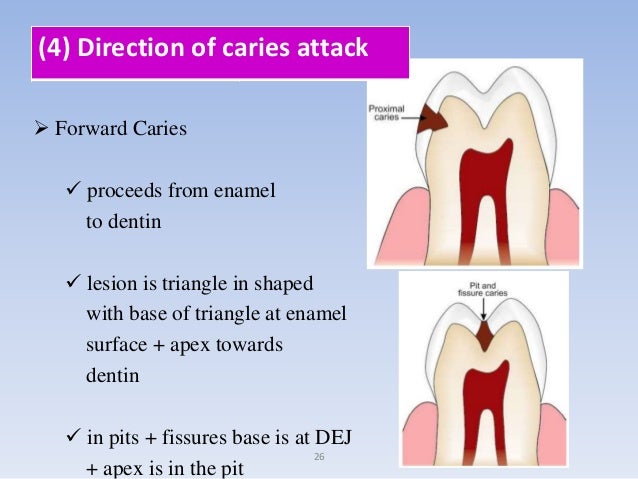 2.dental caries