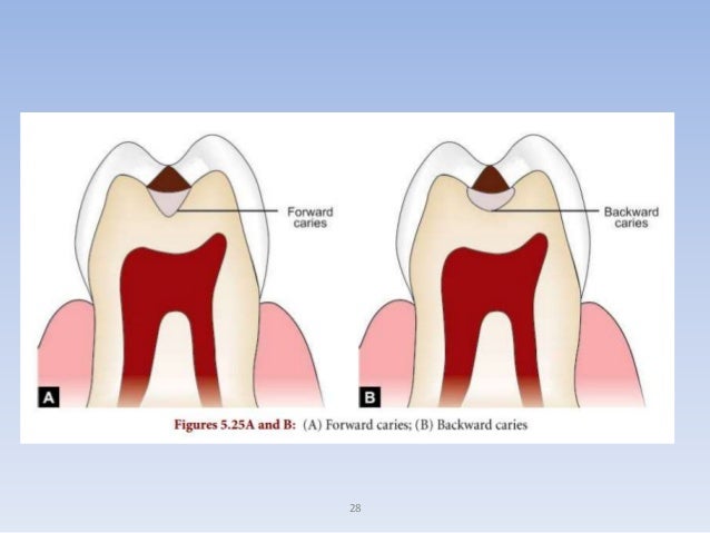 2.dental caries
