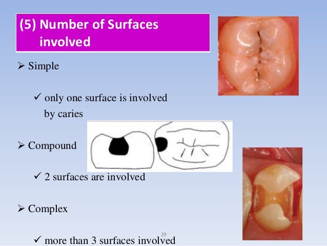 2.dental caries