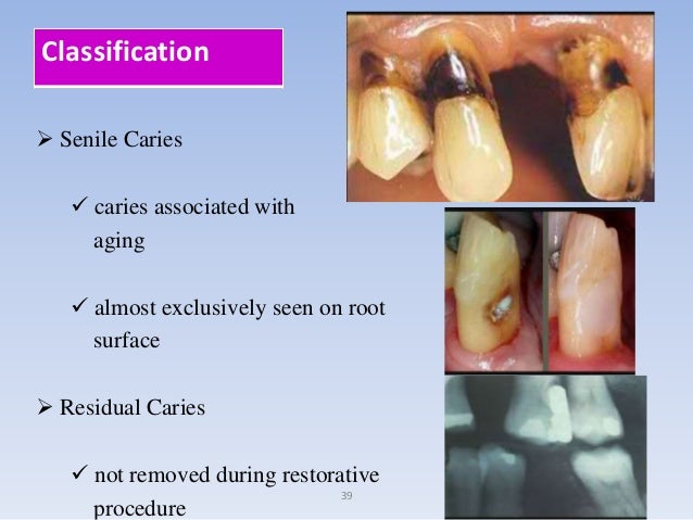 2.dental caries
