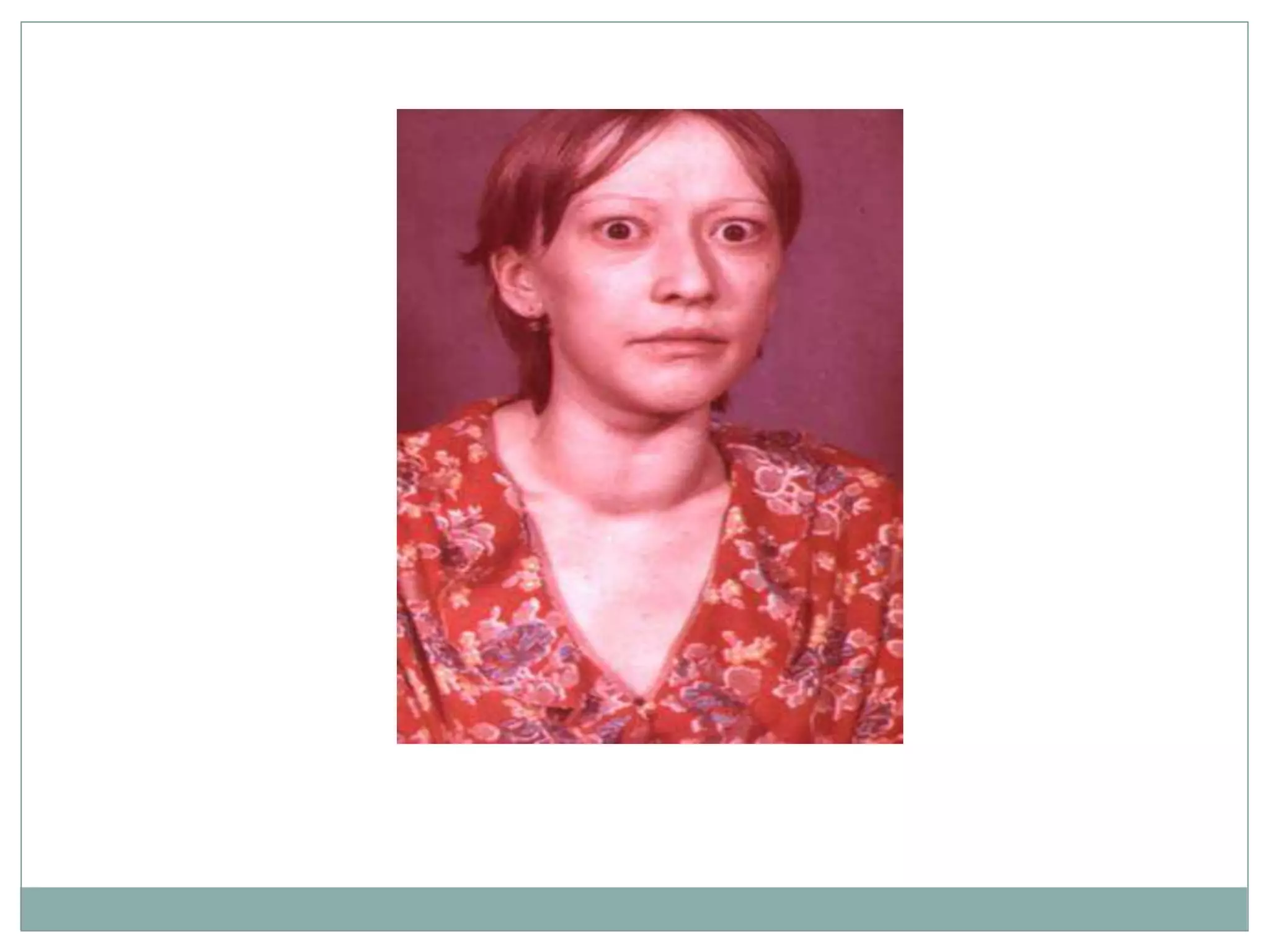 2. classification of goitre | PPTX