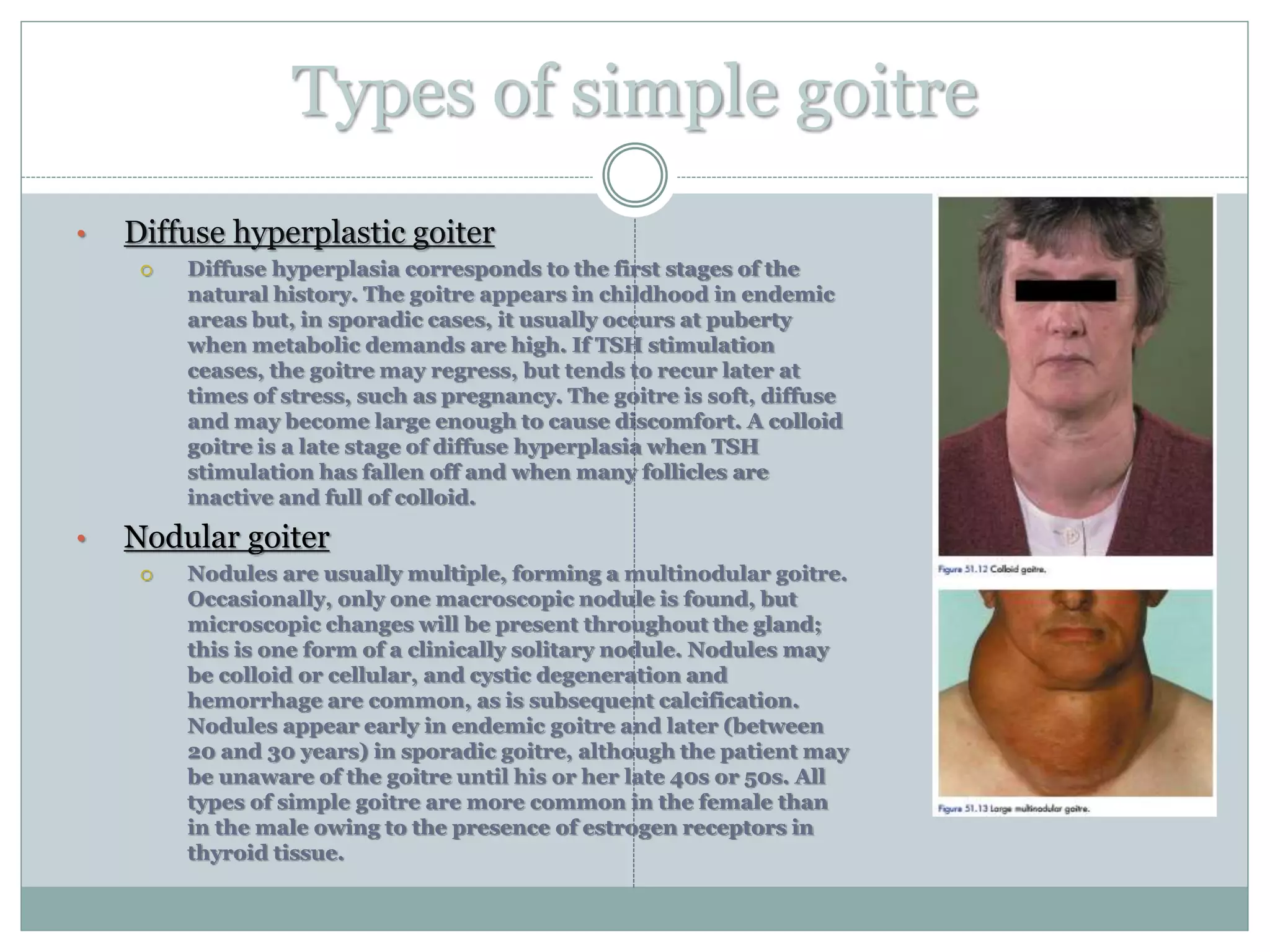 2. classification of goitre | PPTX