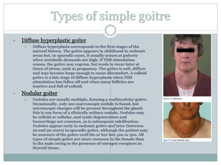 2. classification of goitre | PPTX