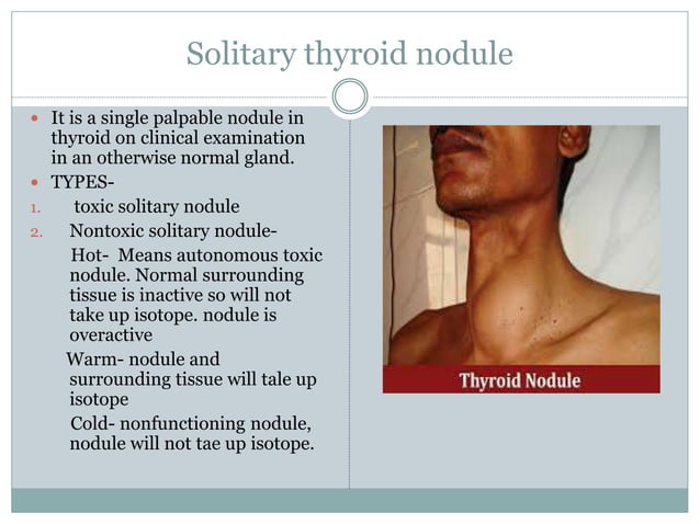2. classification of goitre | PPTX
