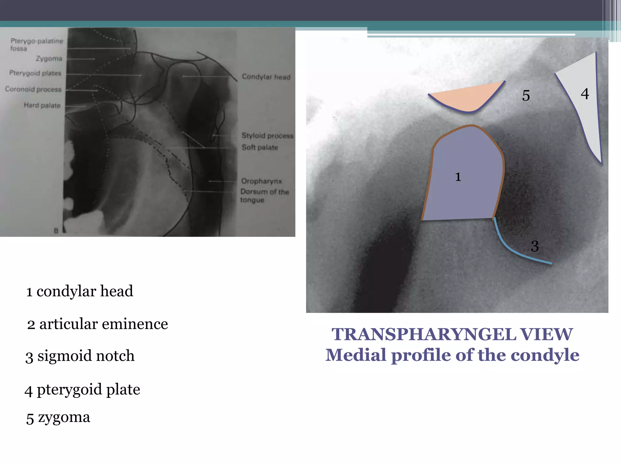 TMJ Radiology & Applied Aspect | PPTX