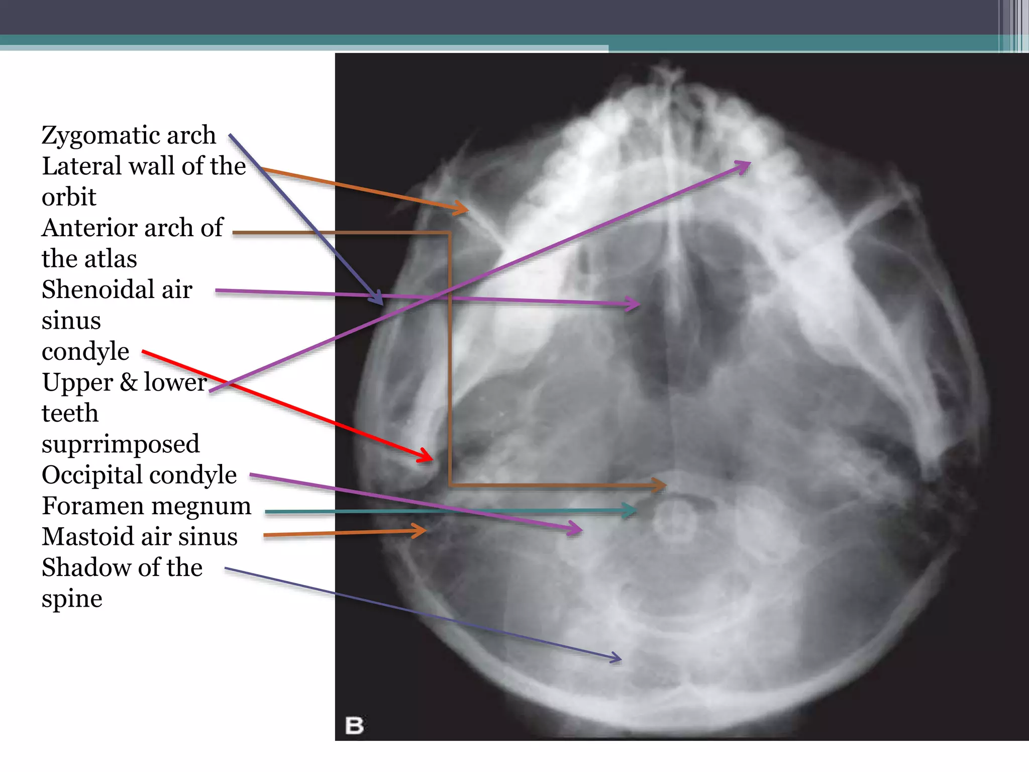 TMJ Radiology & Applied Aspect | PPTX