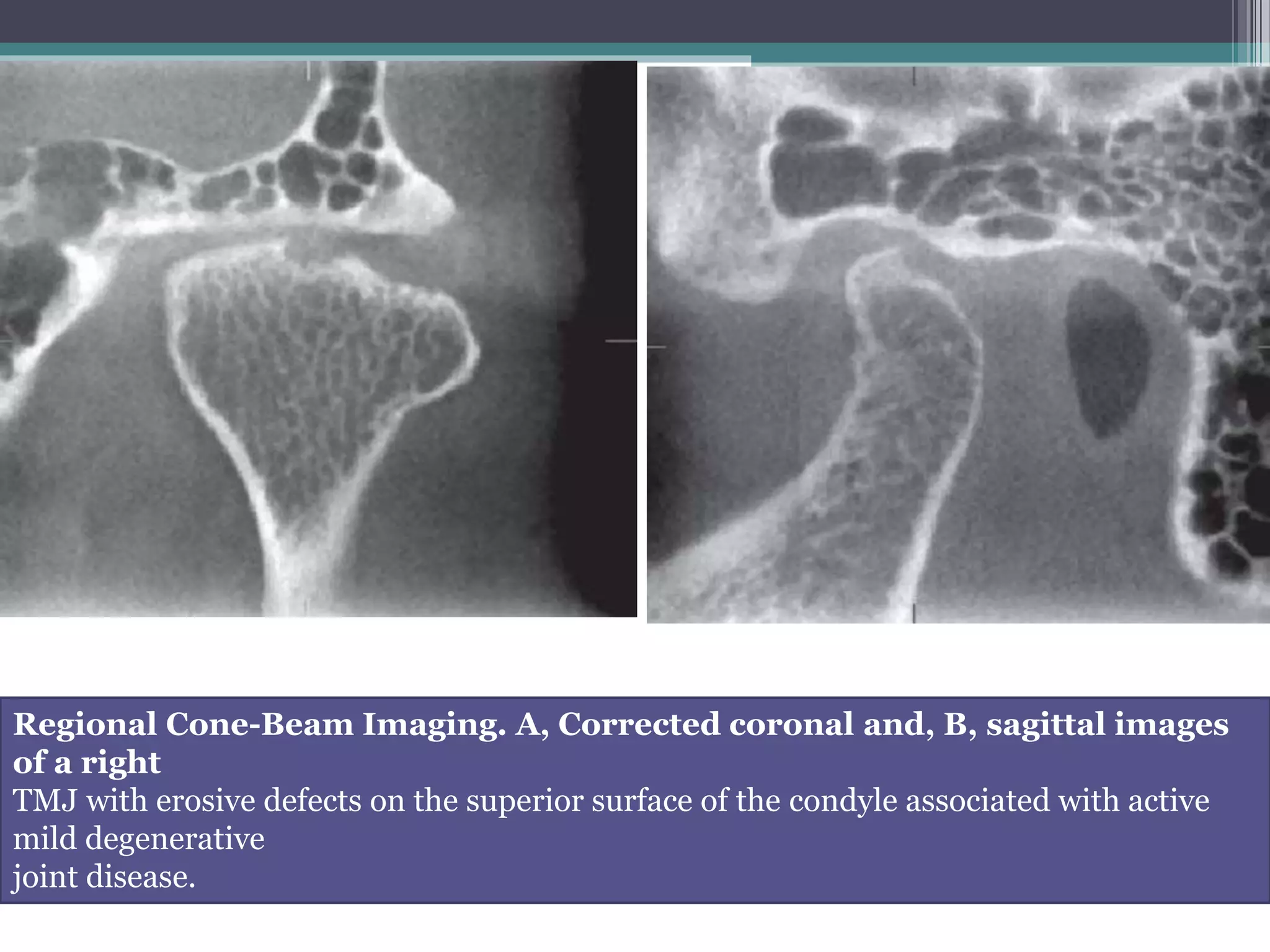 TMJ Radiology & Applied Aspect | PPTX