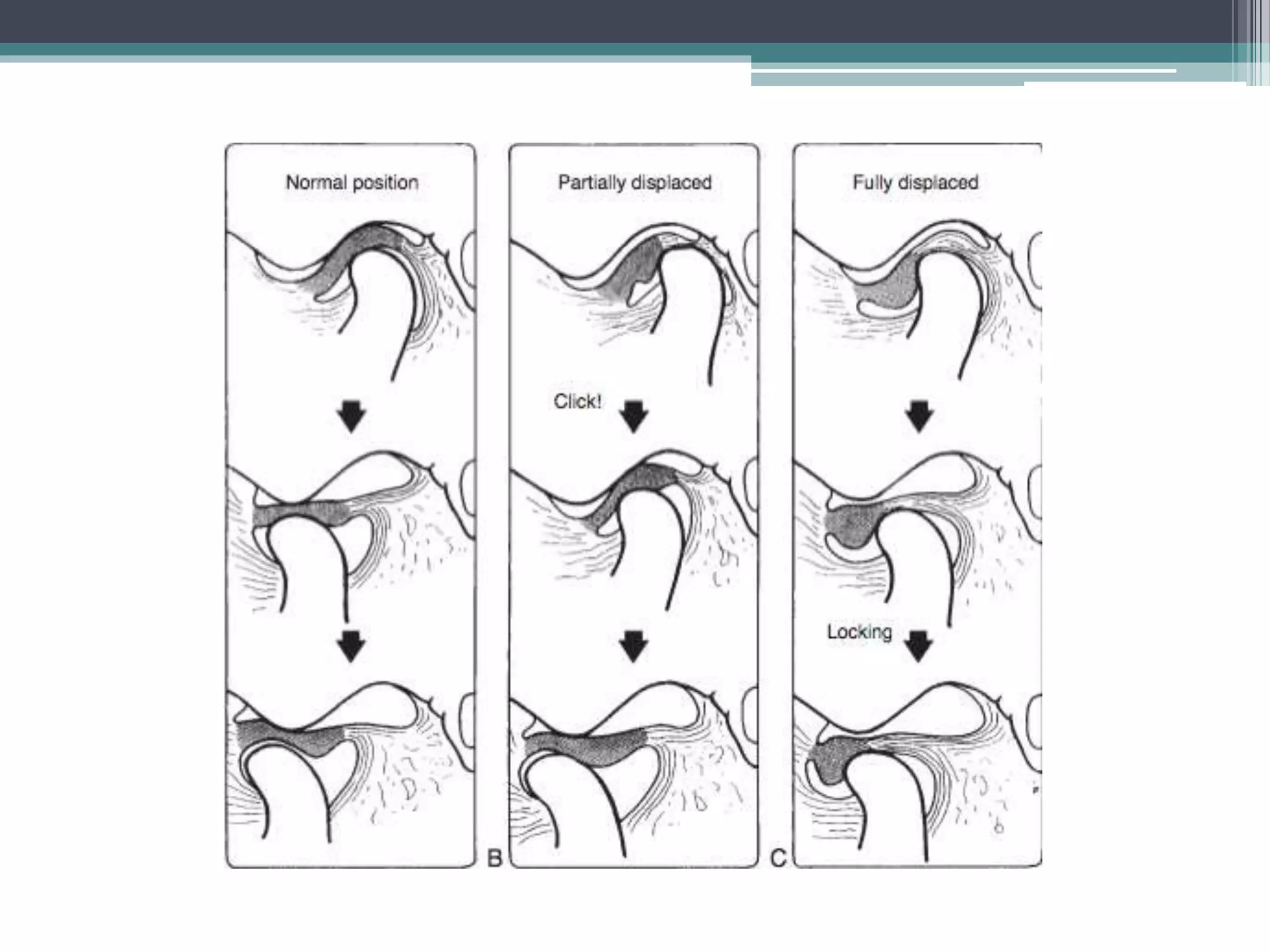 TMJ Radiology & Applied Aspect | PPTX | Bone and Joint Conditions ...