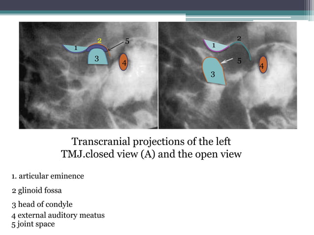 TMJ Radiology & Applied Aspect | PPTX | Bone and Joint Conditions ...