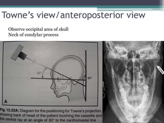 TMJ Radiology & Applied Aspect | PPT