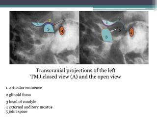 TMJ Radiology & Applied Aspect | PPT