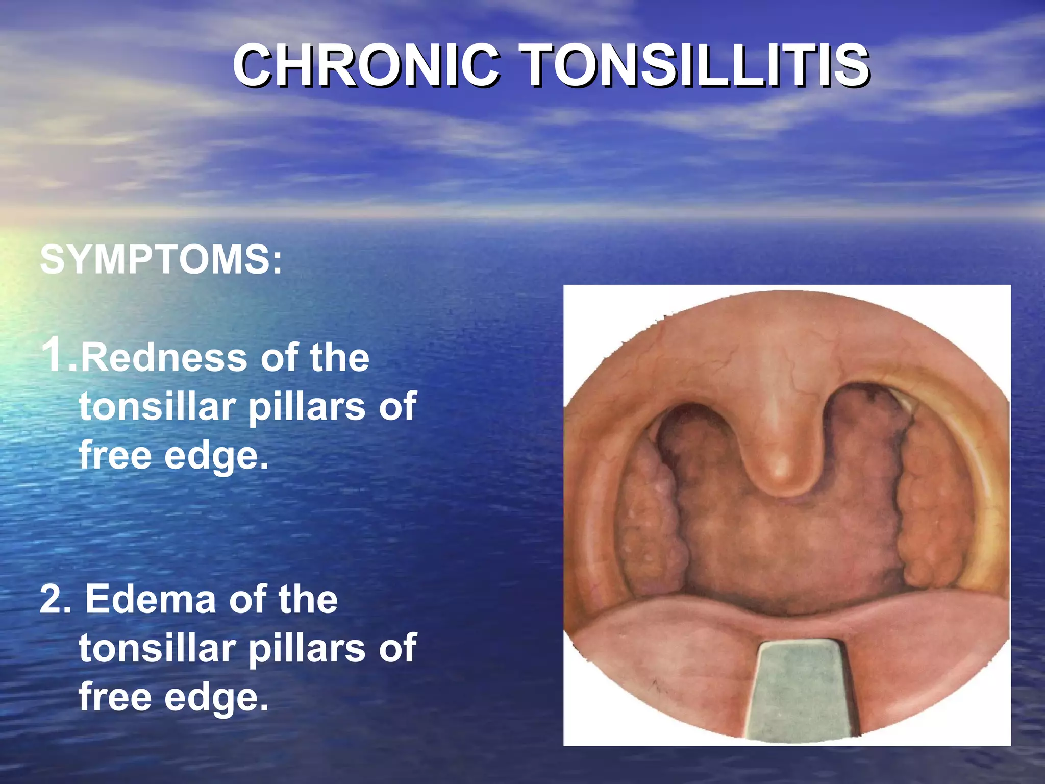 Anatomy & Physiology of pharynx. Tonsillitis | PPT