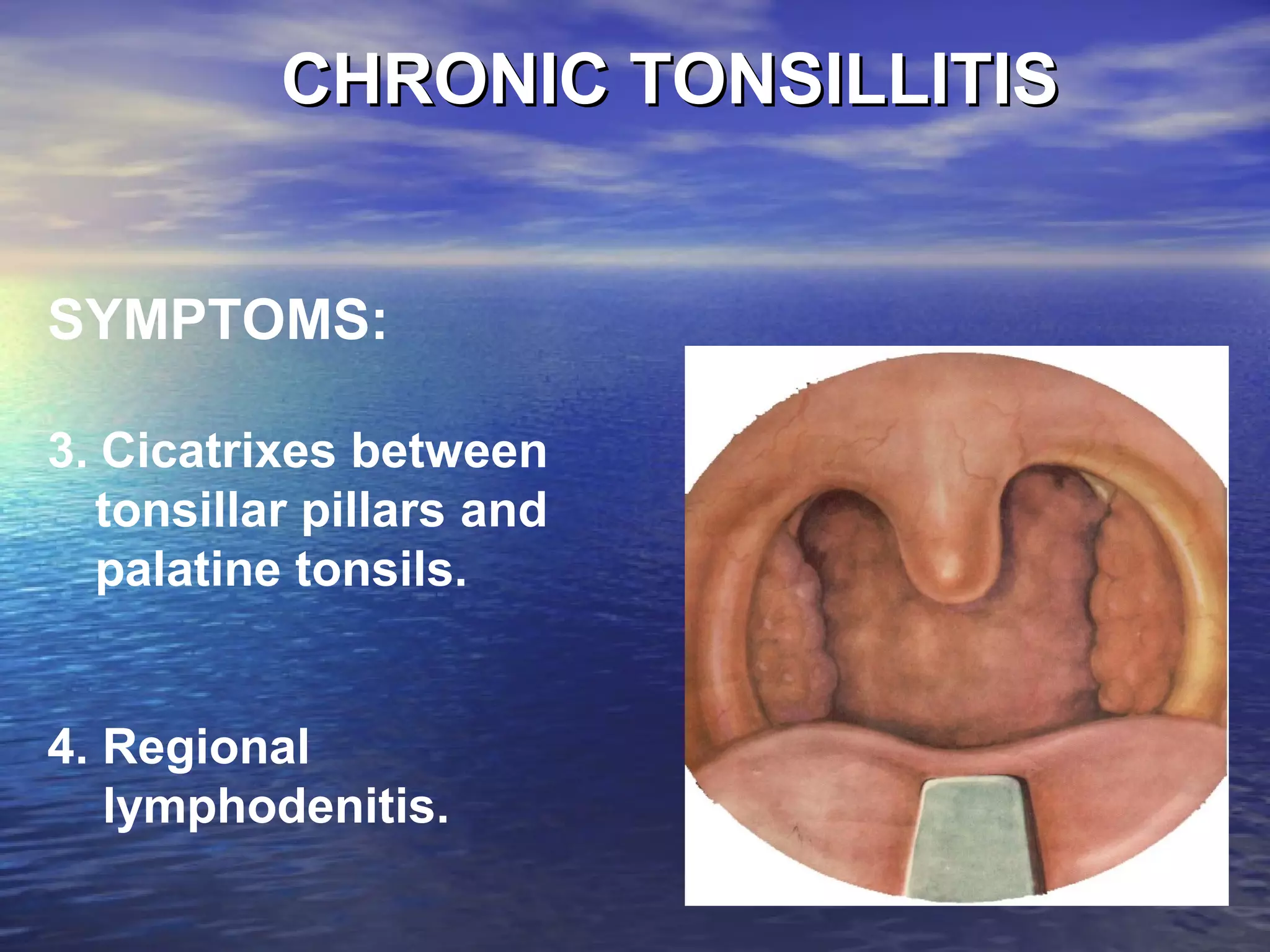 Anatomy & Physiology of pharynx. Tonsillitis | PPT