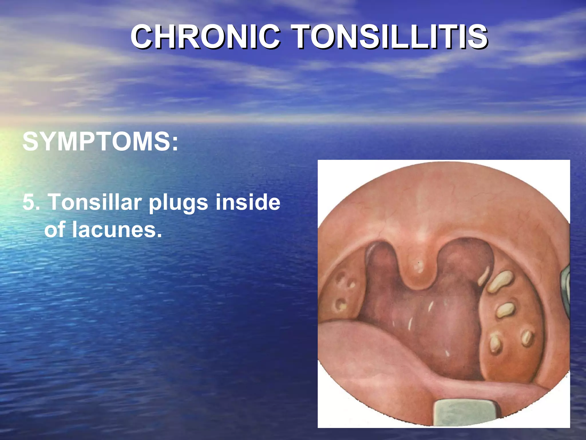 Anatomy & Physiology of pharynx. Tonsillitis | PPT