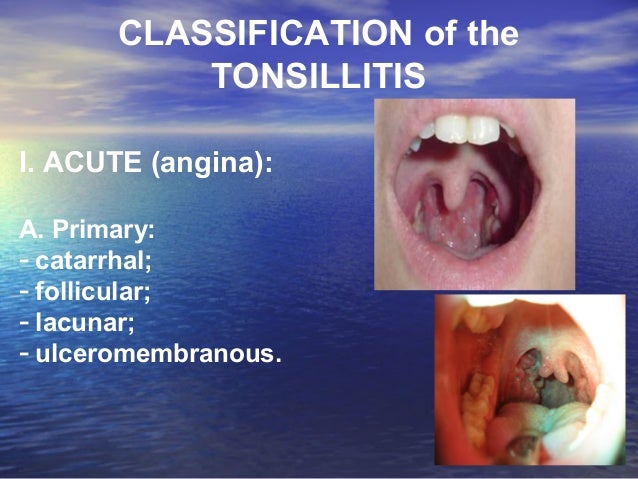 Anatomy & Physiology of pharynx. Tonsillitis