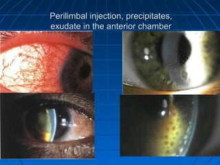 Disorders of cornea. Diseases of Uveal tractus | PPT