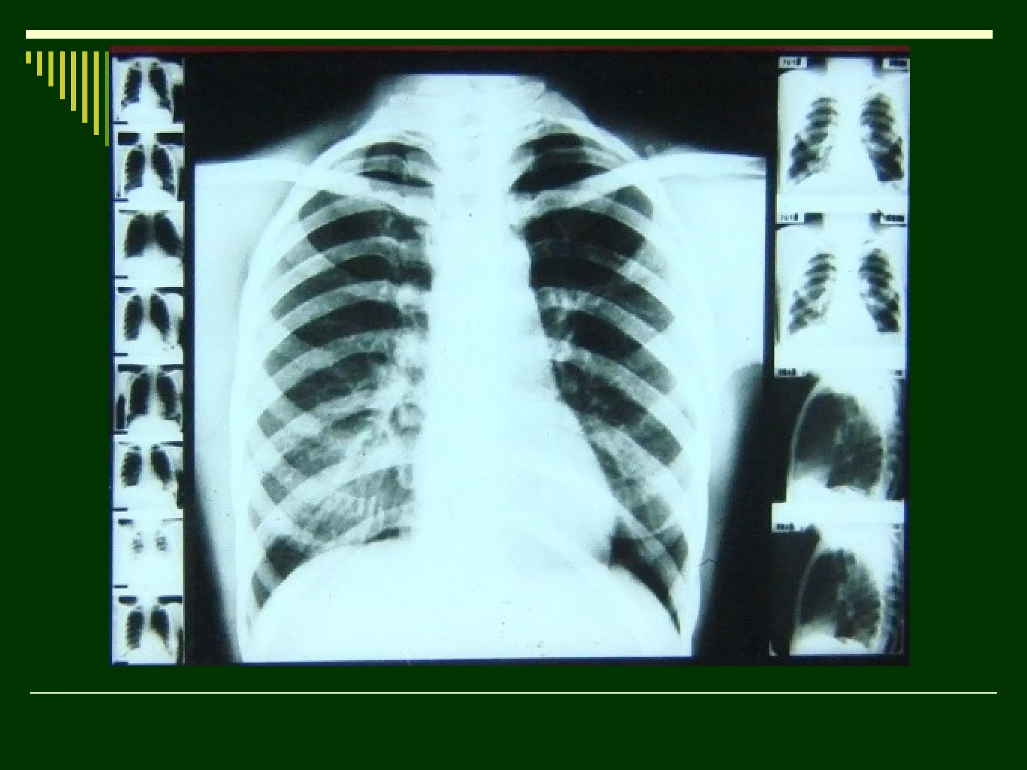Radiological diagnostics of Respiratory system | PPT | Lung and ...