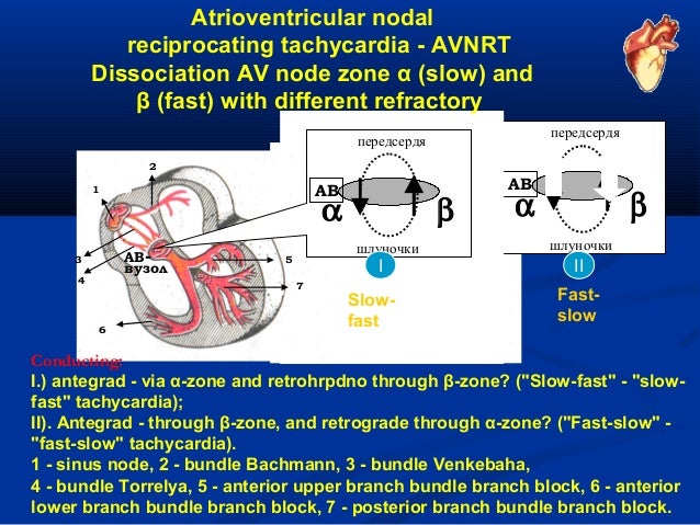 Arrhythmia. Irregular Heartbeat