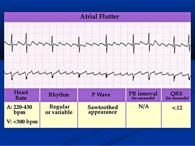 Arrhythmia. Irregular Heartbeat