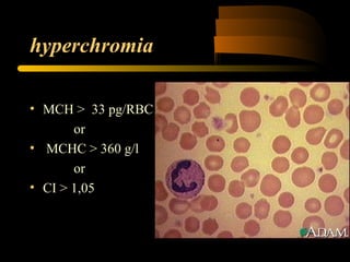 Iron Deficiency Anemia. B12 & Folat Deficiency Anemia | PPT
