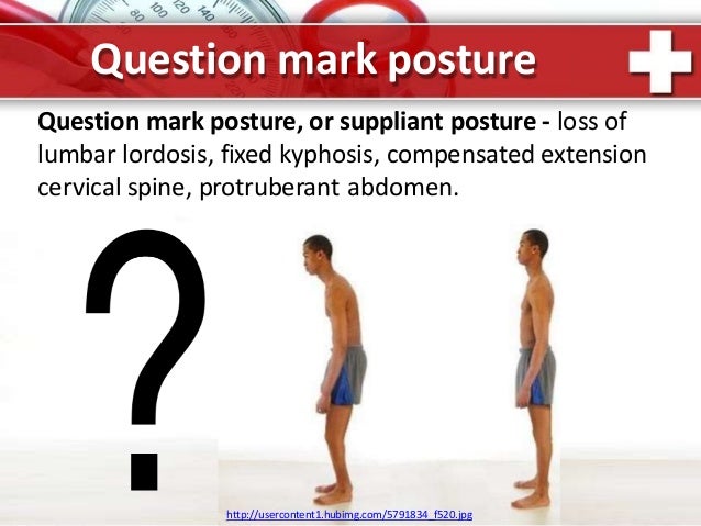 Ankylosing Spondylitis