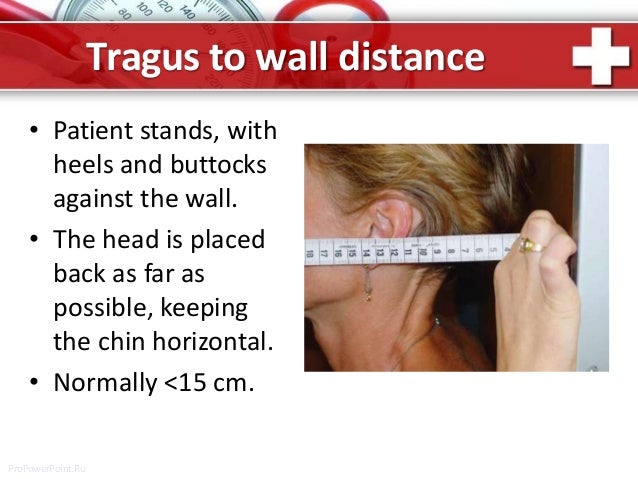 Ankylosing Spondylitis