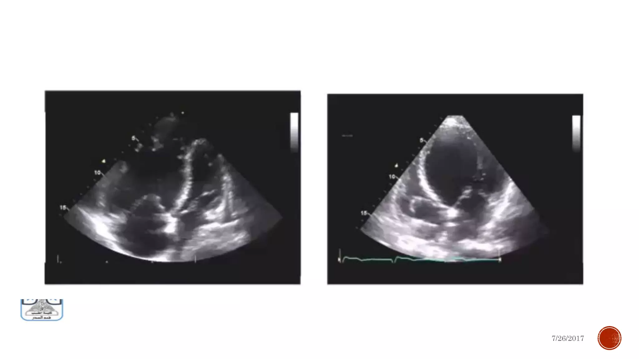 Basic Echocardiography for Pulmonologists and Intensivists | PPTX ...