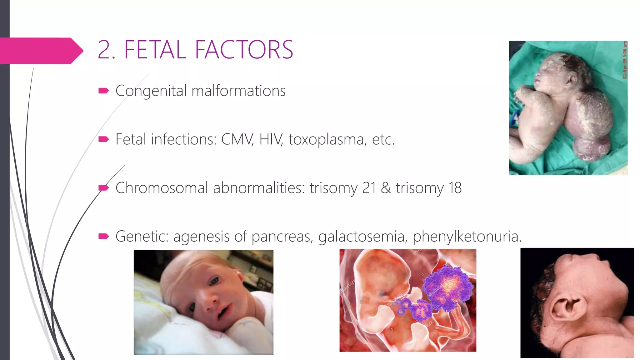 Intrauterine Growth Restriction (IUGR) / Small For gestational Age | PPTX