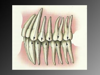 2.wax pattern by lundeen | PPT